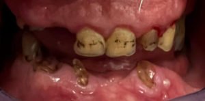 Infinityblu Dental Implants - The Confidence to Smile Again