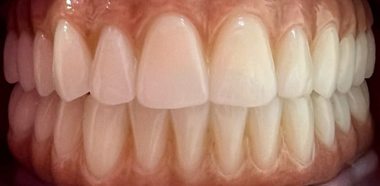 Infinityblu Dental Implants - The Confidence to Smile Again