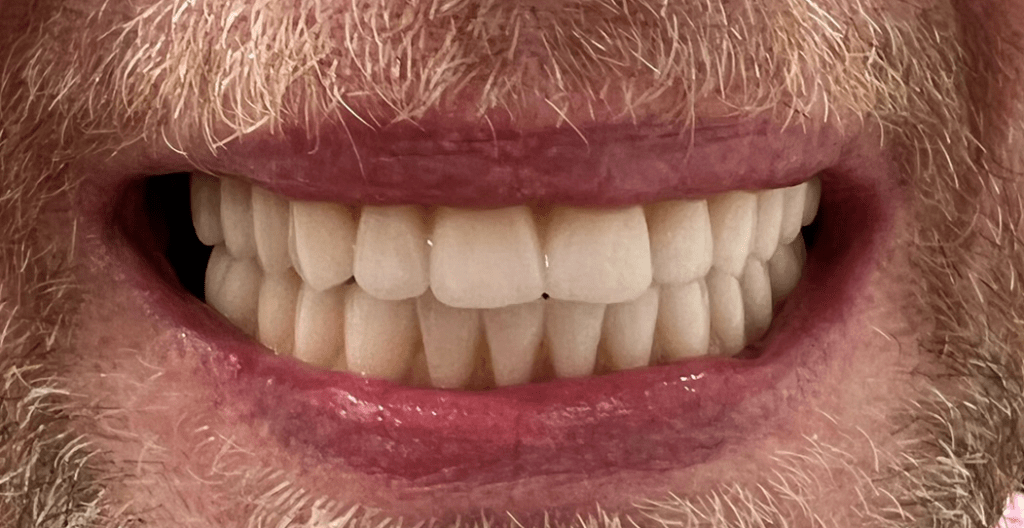 Chrome GuidedSMILE - Infinityblu Dental Implants