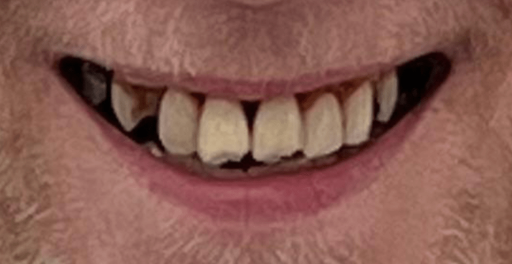 Infinityblu Dental Implants - The Confidence to Smile Again