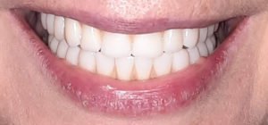 Infinityblu Dental Implants - The Confidence to Smile Again